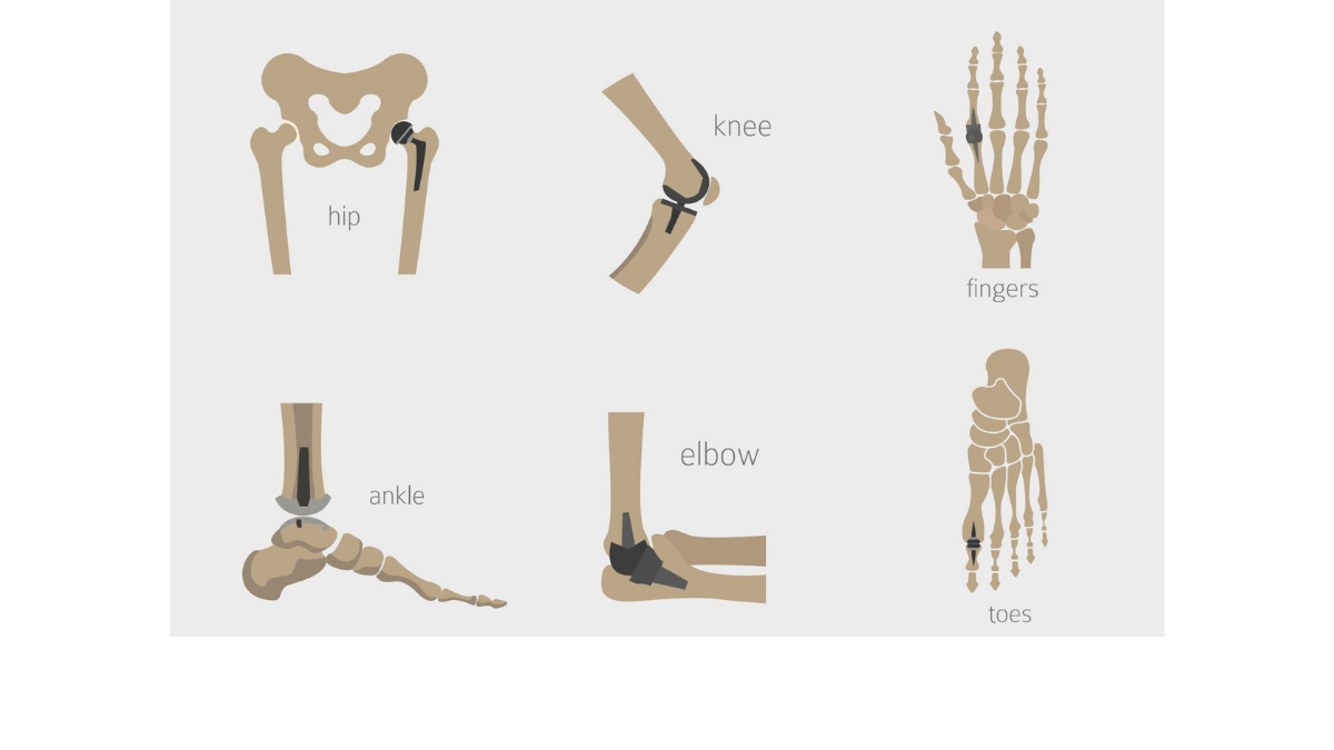 Orthopedic Implants, Part 1 – Surface Finishing Enhances Component Life ...